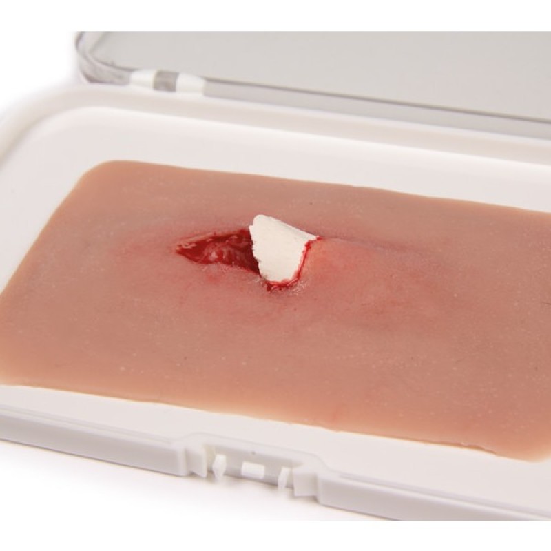 Erler-Zimmer Moulage Open Fracture - MedicalSupplies.co.uk